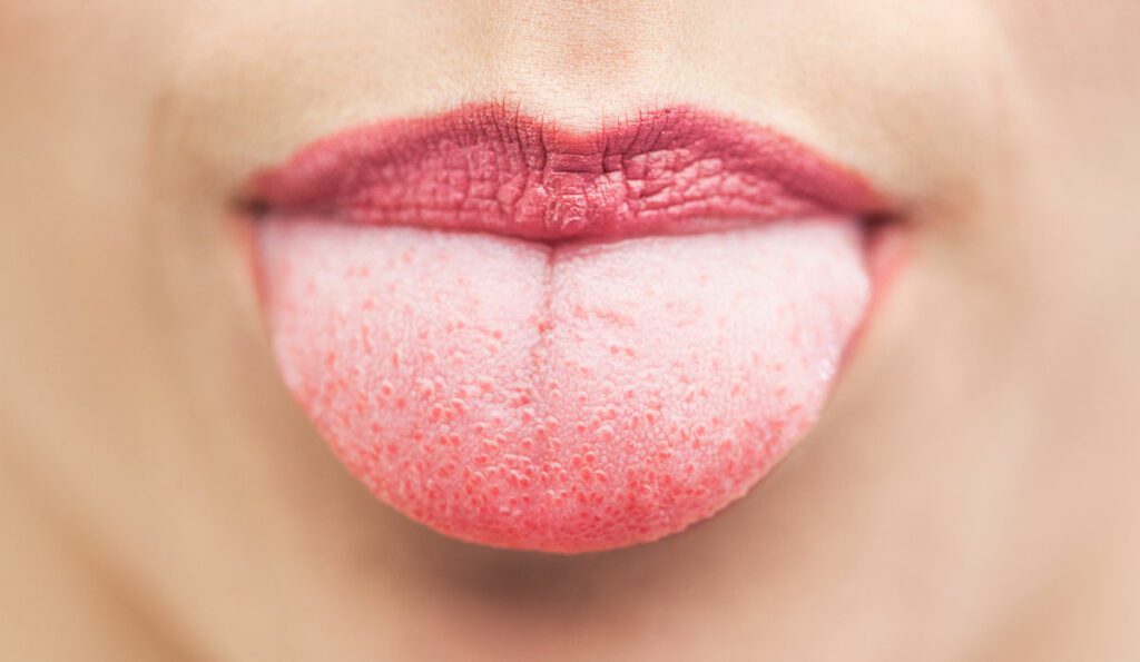 Puntini Rossi sulla Lingua: Cause, Diagnosi e Terapia