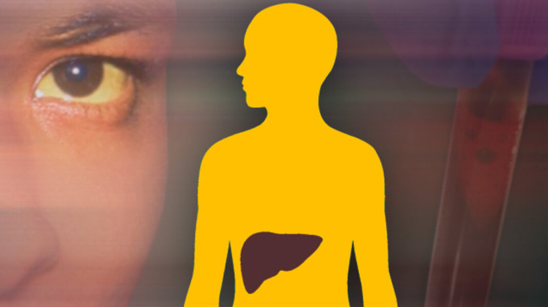 Ittero: cause, sintomi, diagnosi, trattamento